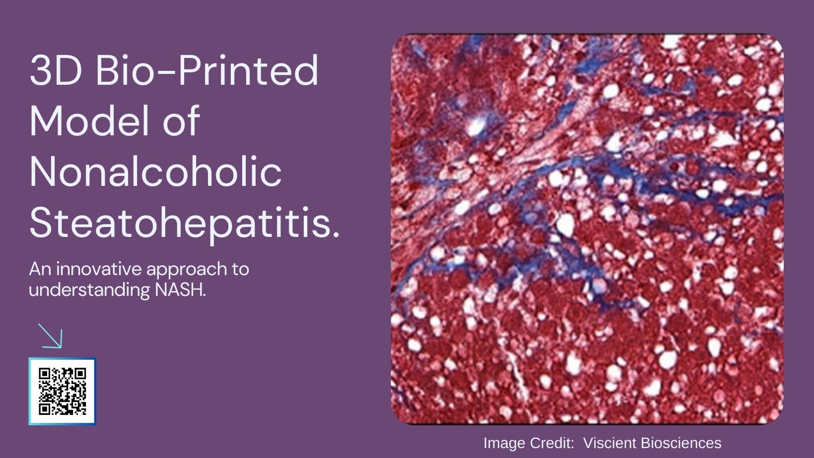 3D Bioprinted Model of Nonalcoholic Steatohepatitis (NASH) - Medical ...