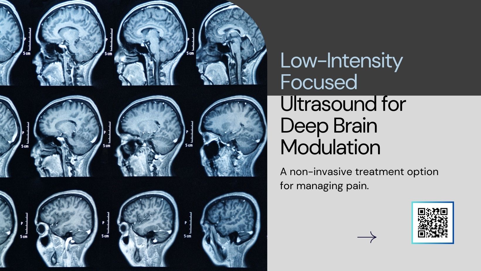 Low-Intensity Focused Ultrasound Deep Brain Modulation For Pain ...